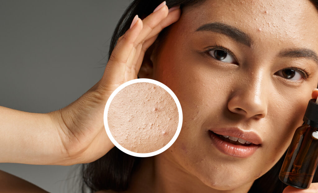 Milia (Oil Clogs, Whiteheads) - True Harmony